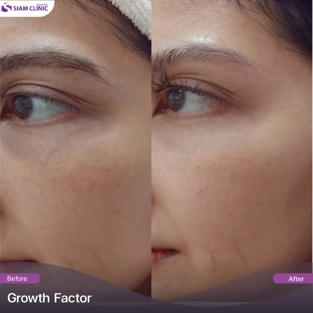 Growth Factor Review - Siam Clinic - Aesthetic & Wellness Clinic in Phuket
