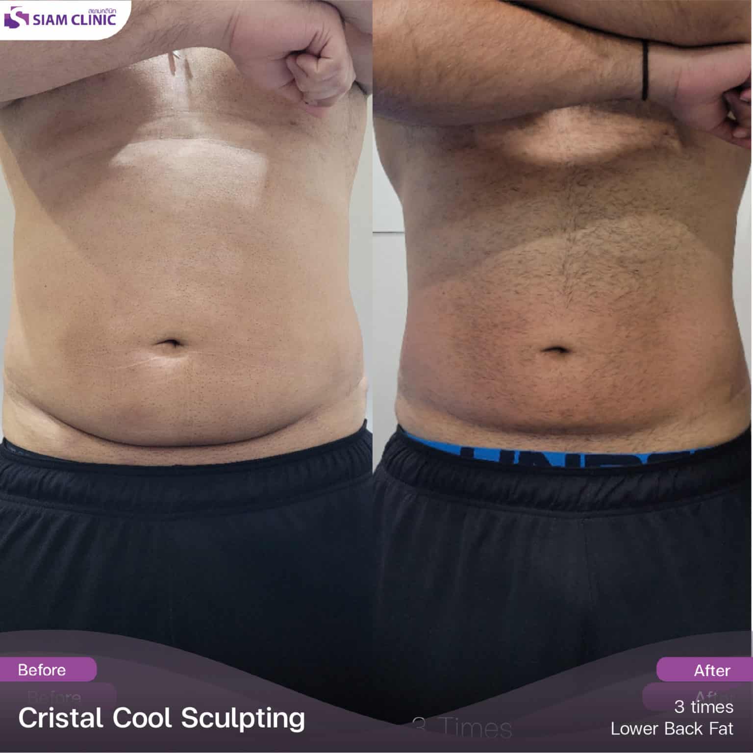 Cristal Cryolipolysis result - Siam Clinic - Aesthetic & Wellness ...