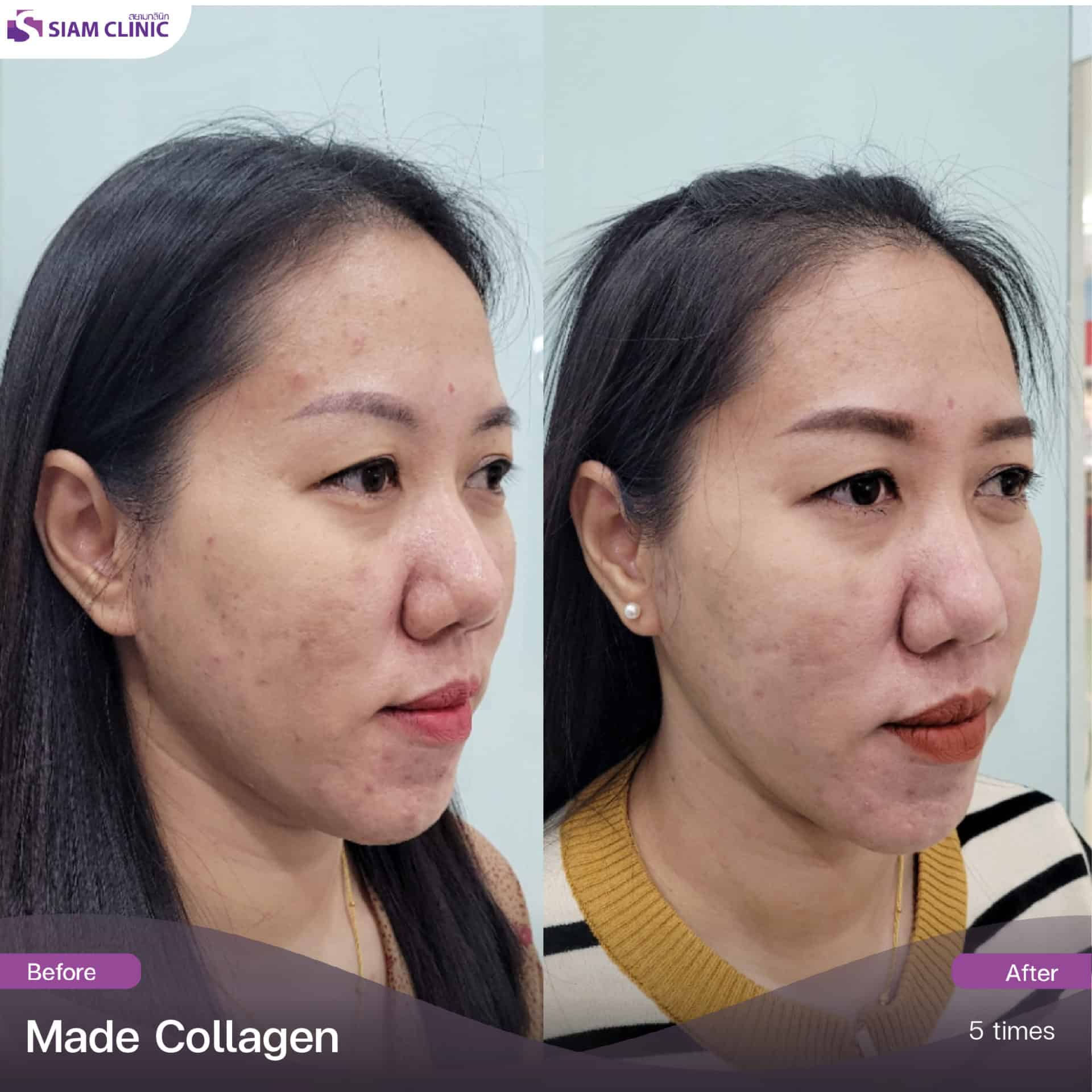 MADE Injection Case Review - Siam Clinic - Aesthetic & Wellness Clinic ...