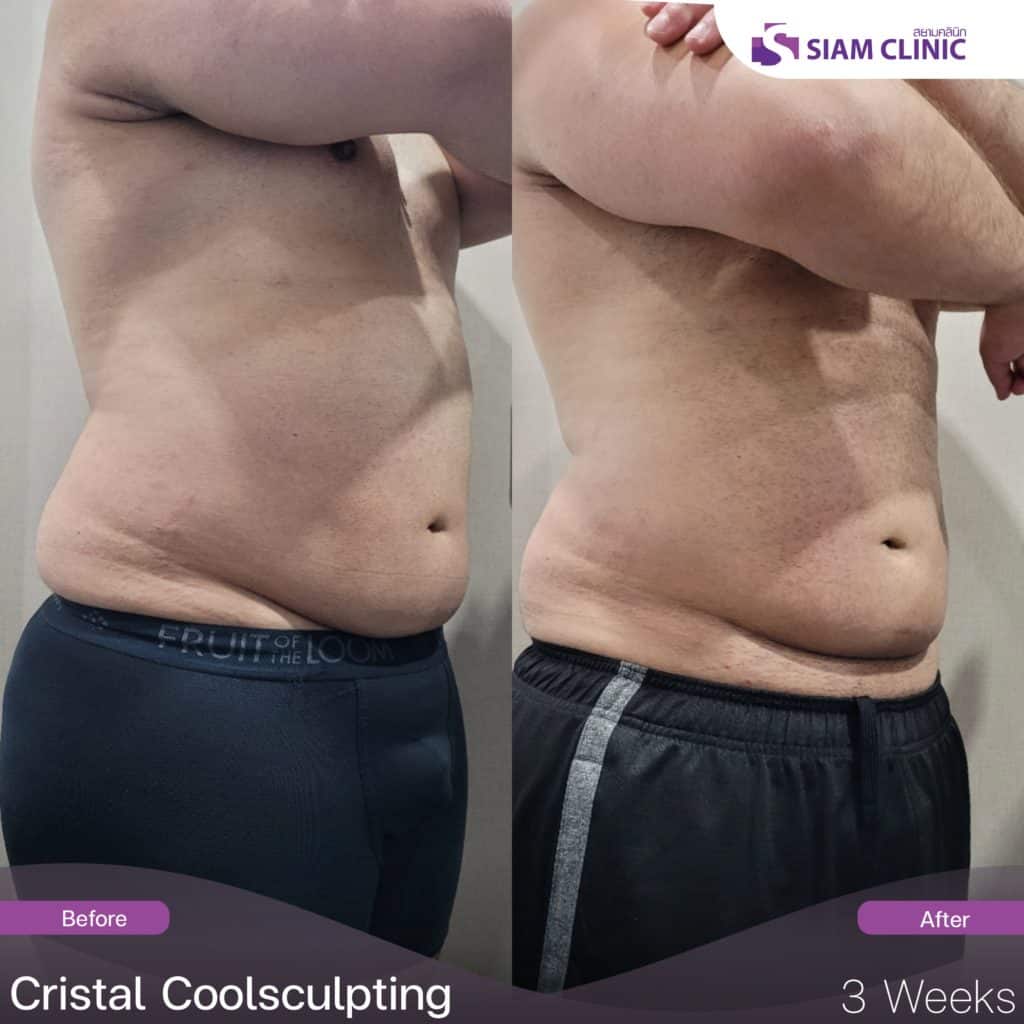 Cristal Cryolipolysis result - Siam Clinic - Aesthetic & Wellness ...