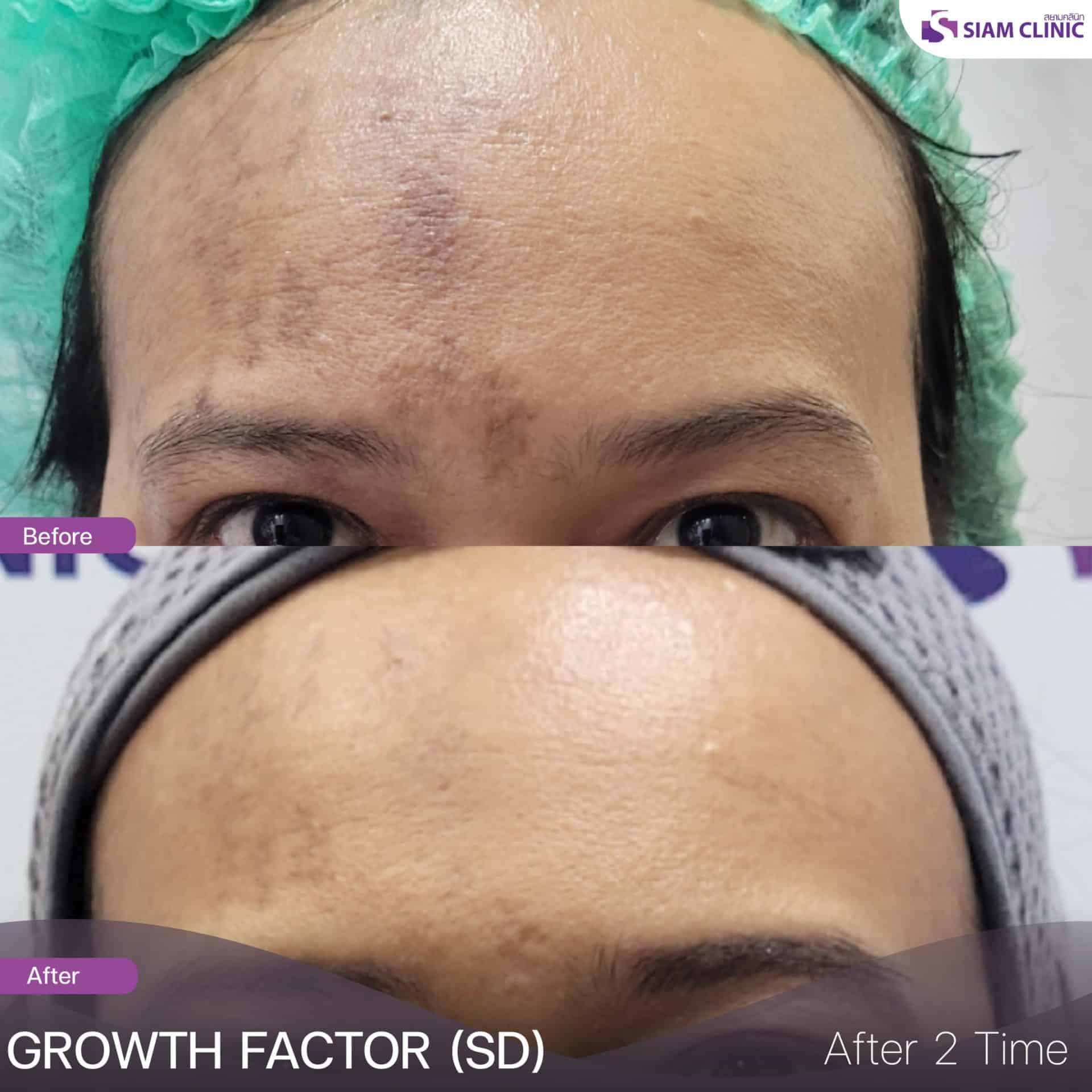 Growth Factor Review - Siam Clinic - Aesthetic & Wellness Clinic in Phuket