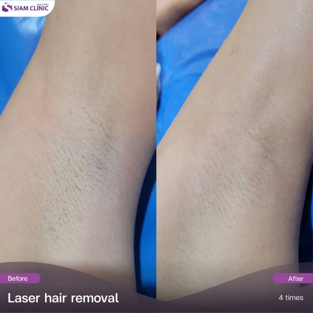 Armpit Laser Hair Removal - Siam Clinic - Aesthetic & Wellness Clinic ...