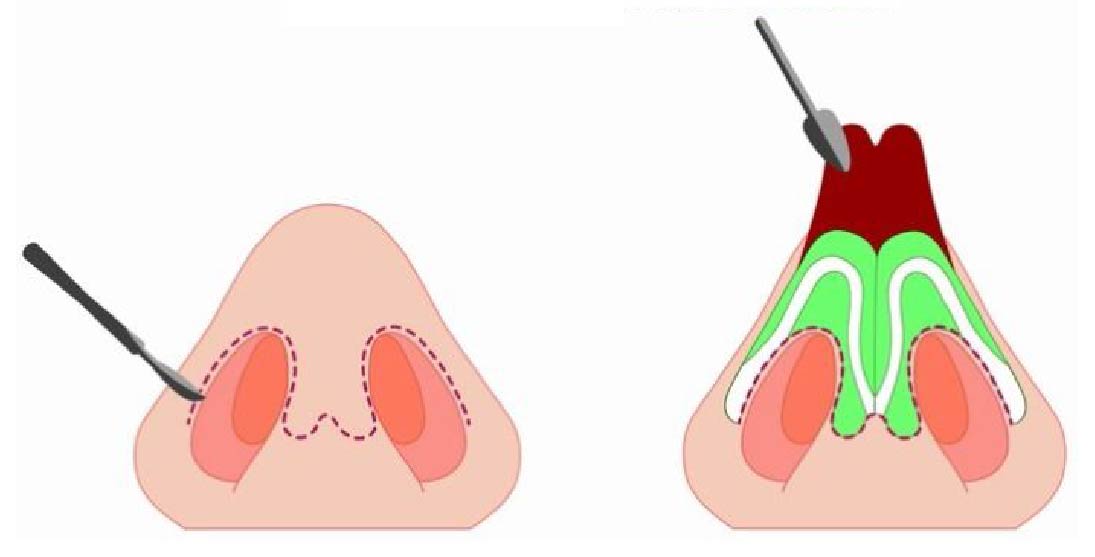 Rhinoplasty - Siam Clinic - Aesthetic & Wellness Clinic in Phuket