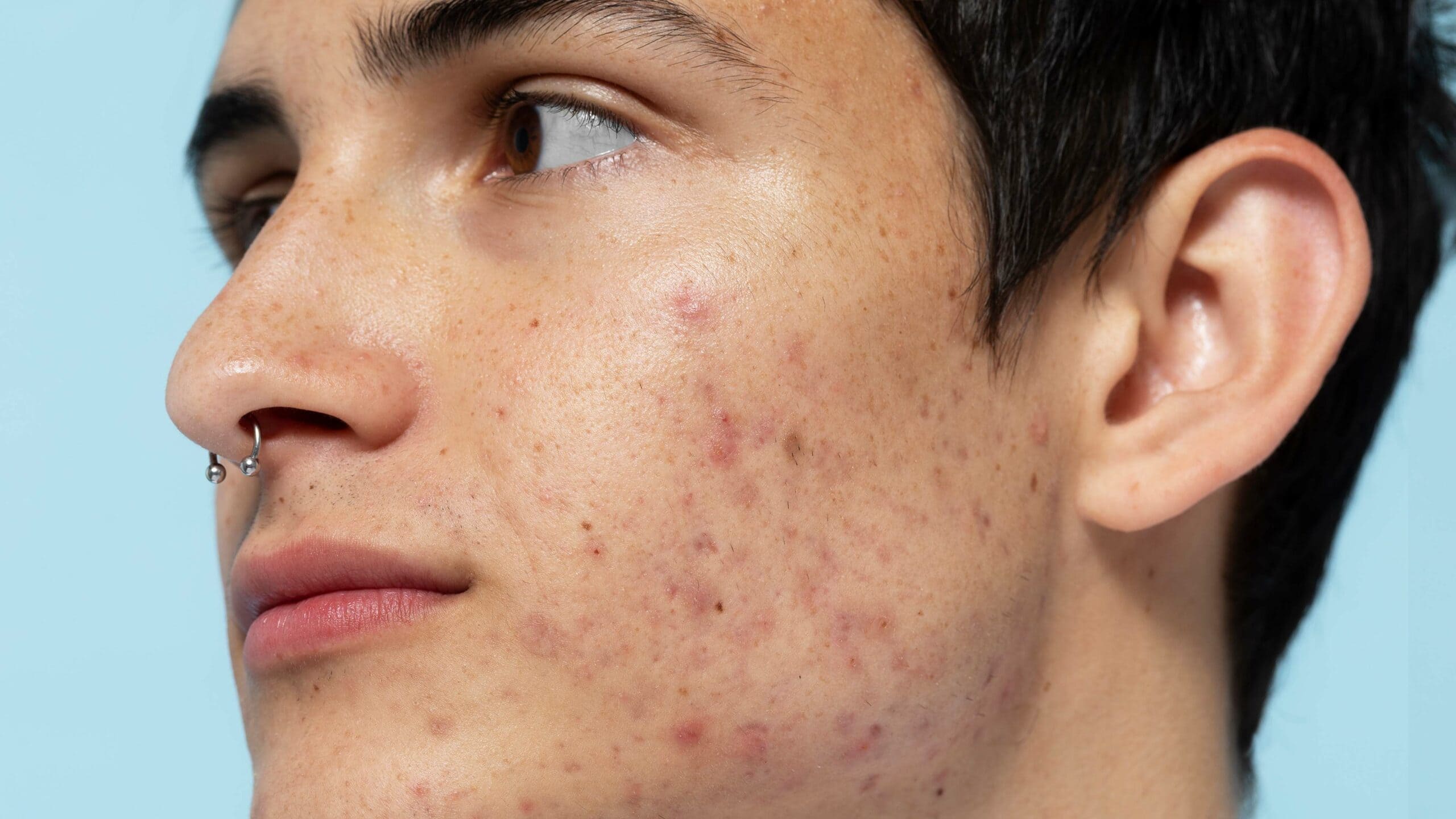 All you need to know about Acne - Siam Clinic - Aesthetic & Wellness ...