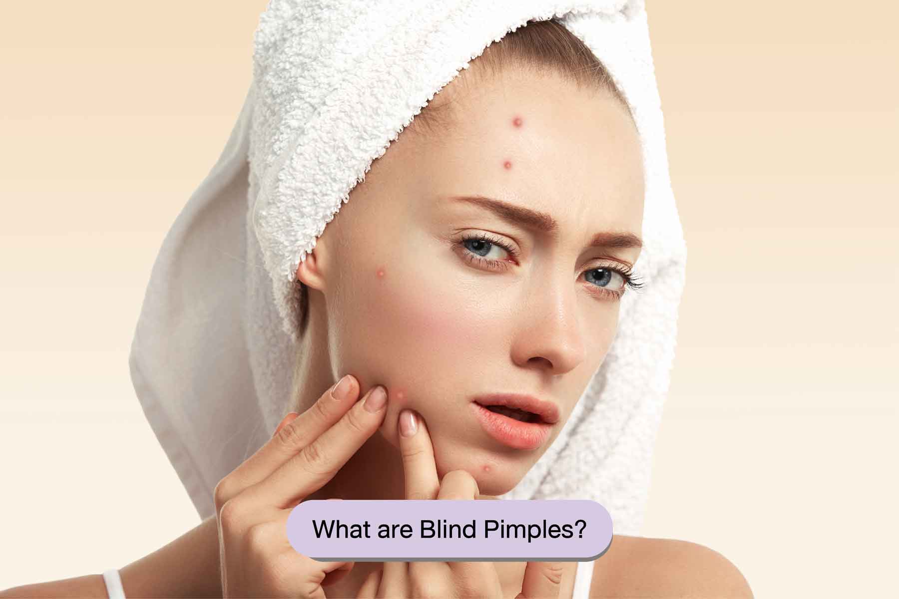 What are Blind Pimples? - Siam Clinic - Aesthetic & Wellness Clinic in ...